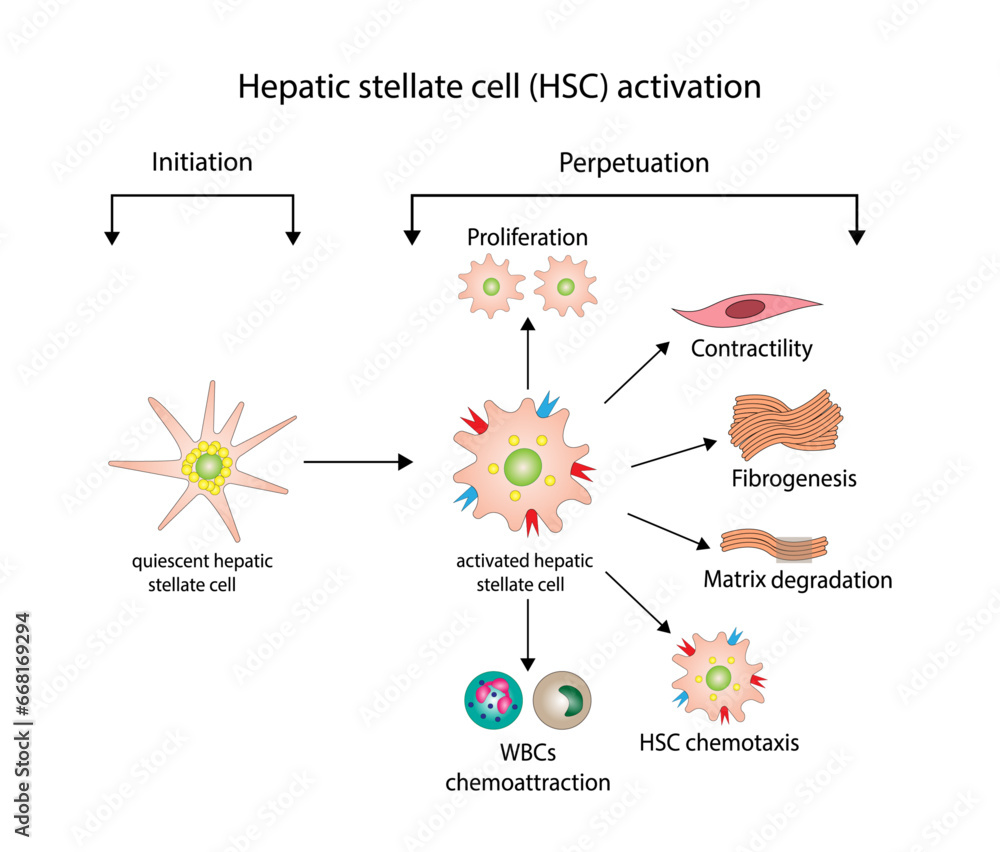 hepatic stellate cell (HSC) activation involving initiation and ...