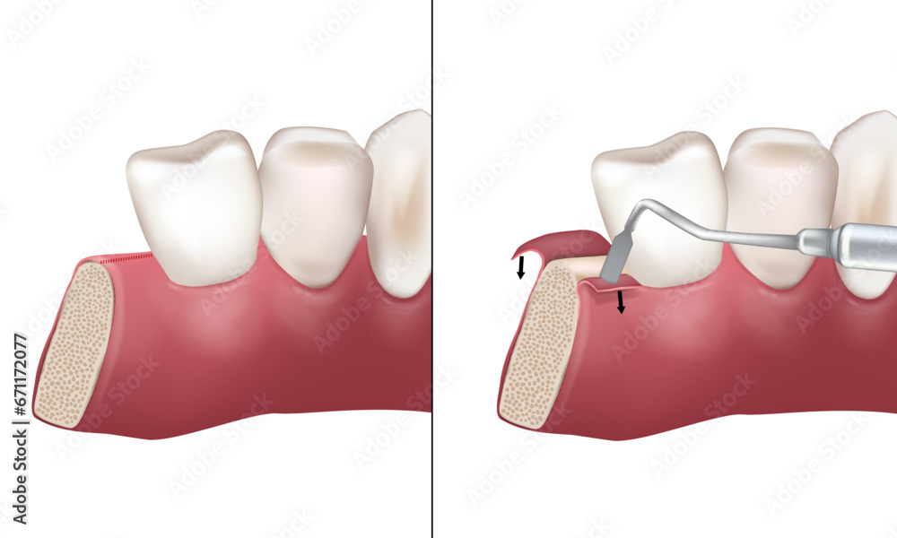 Mid-crestal incision used during implant bed preparation. Paracrestal ...