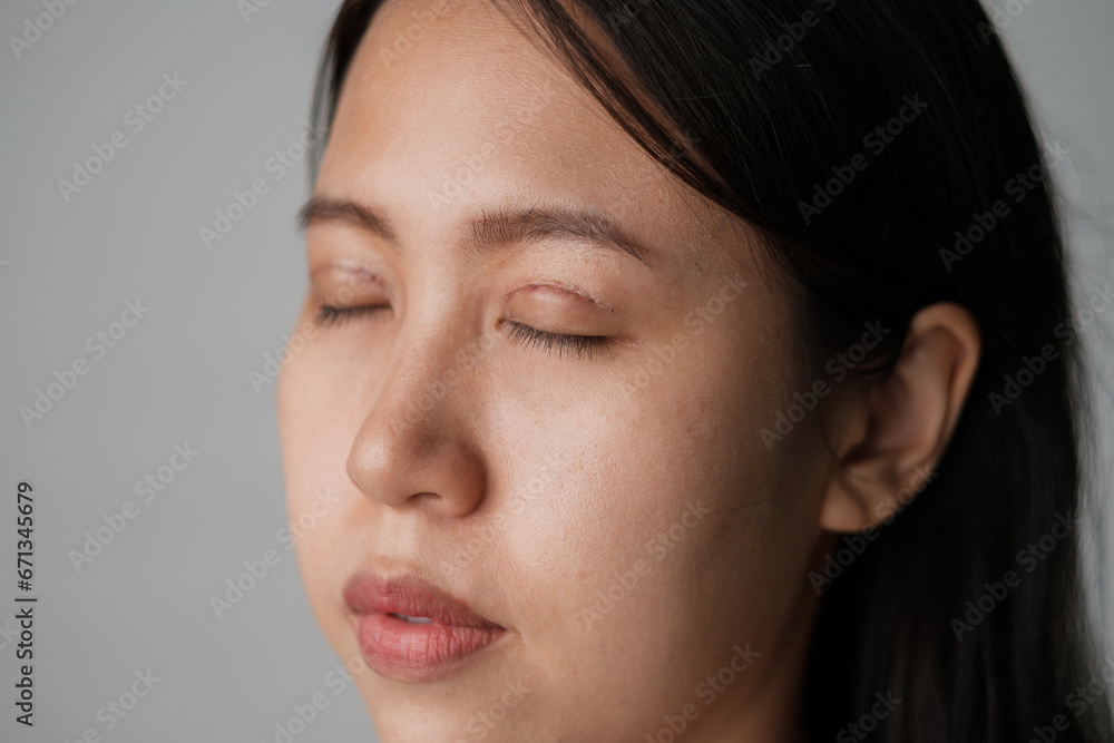 Asian woman with ongoing upper blepharoplasty surgery concept. Medical ...