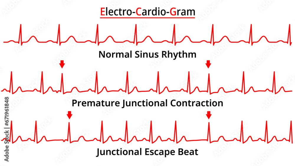 Set of ECG Common Abnormalities - Junctional Escape Beat - Premature ...