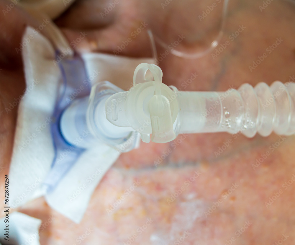 ICU at the hospital. Tracheostomy or tracheotomy is a bypass airway ...