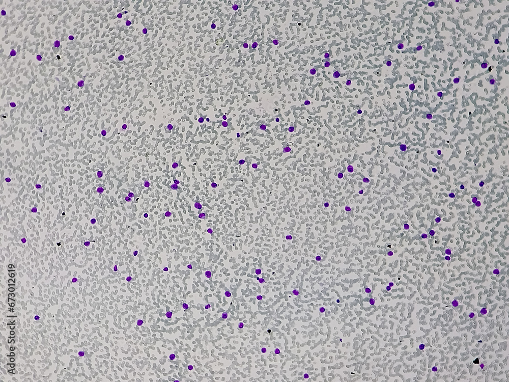 Acute myeloid leukemia (AML) is a type of blood cancer. Microscopic 10x ...