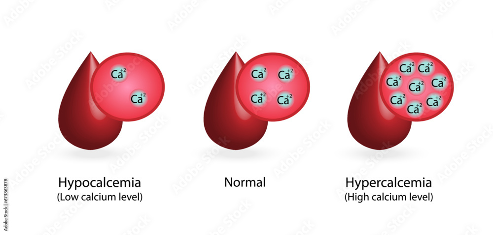 Hypercalcemia, high plasma calcium level and hypocalcemia, low plasma ...