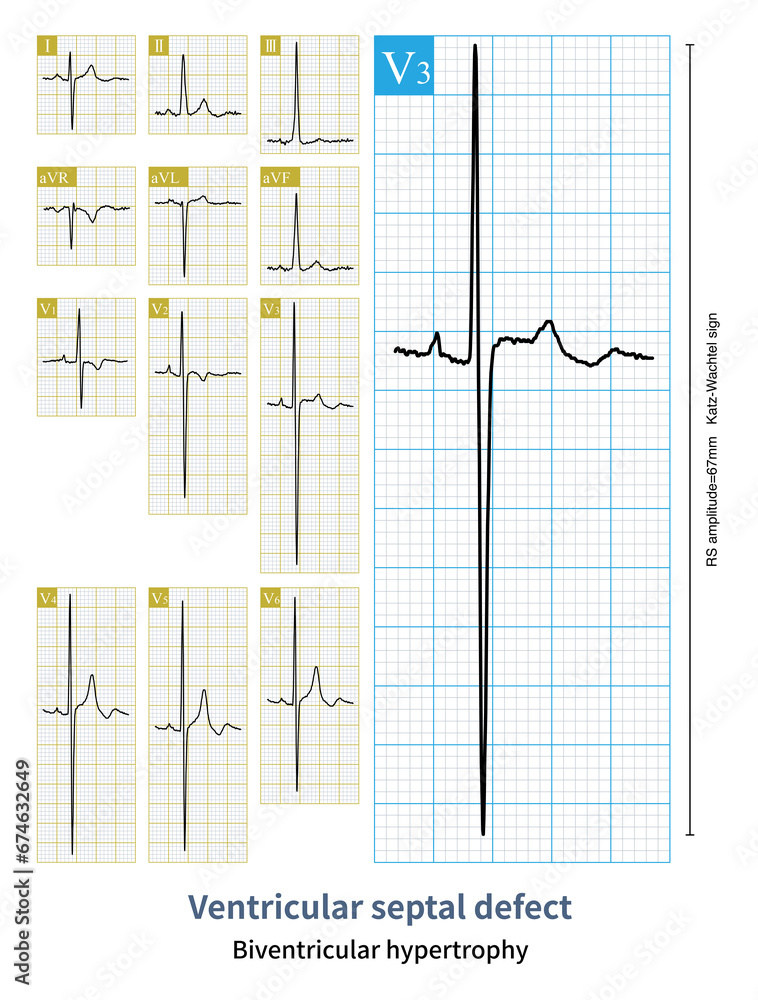 Stock-Illustration „A 19-year-old young man suffering from ventricular ...