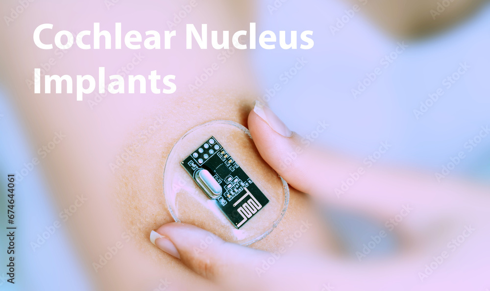Cochlear Nucleus Implants Implantable Electronic Medical Devices Conce ...