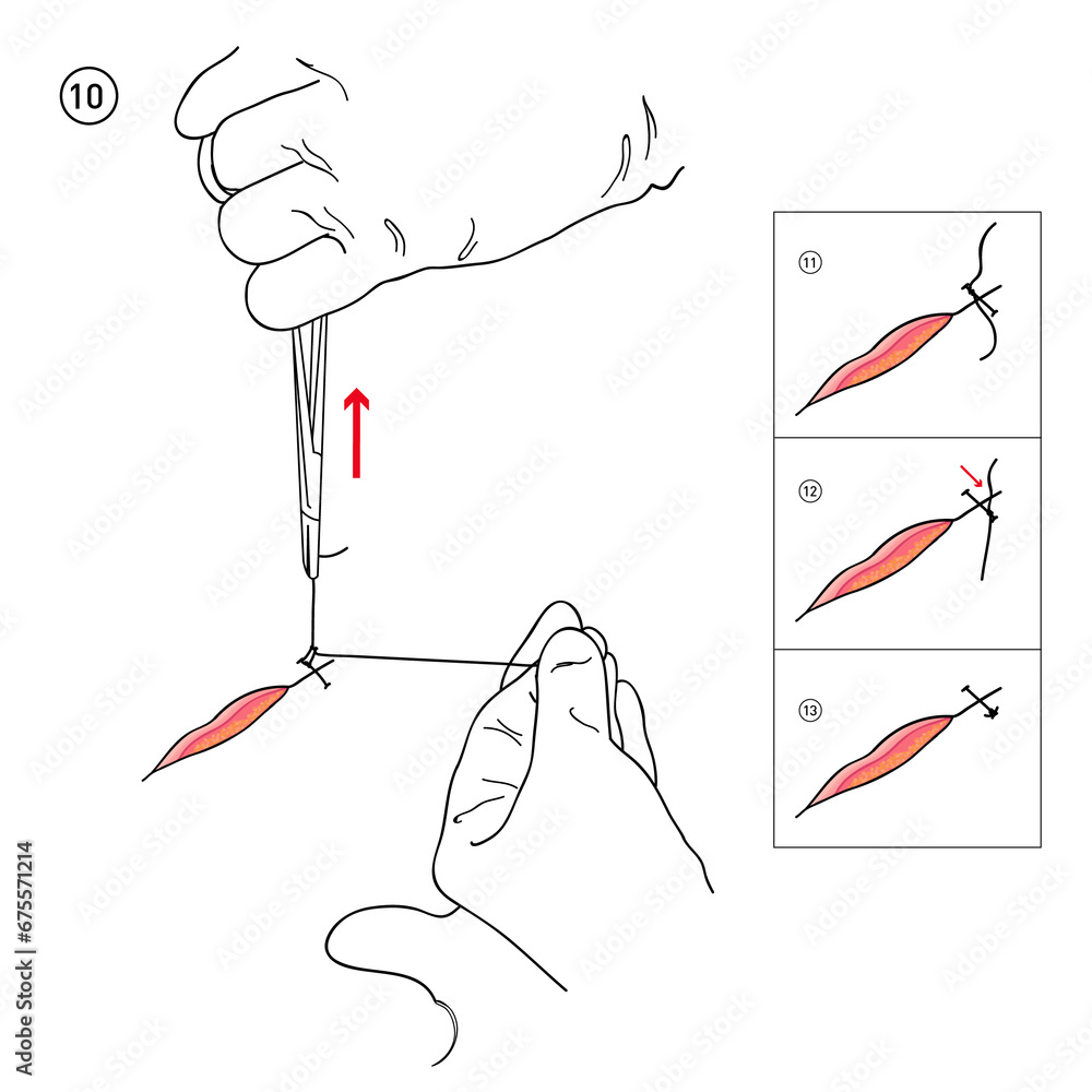 No 10, Simple Suture Techniques Stitching, Incision and Laceration ...
