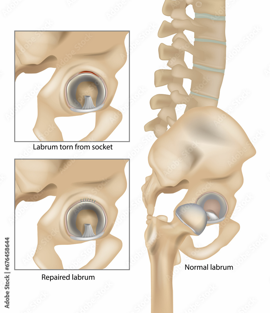Hip Labral Tears. Labrum torn from socket and Repaired labrum. Surgery ...