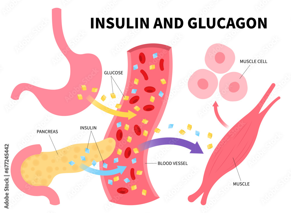 Type of Diabetes mellitus 1 and 2 with insulin injection diagram of ...