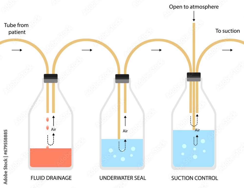 เวกเตอร์ Stock Three bottle system of chest tube insertion Tube ...