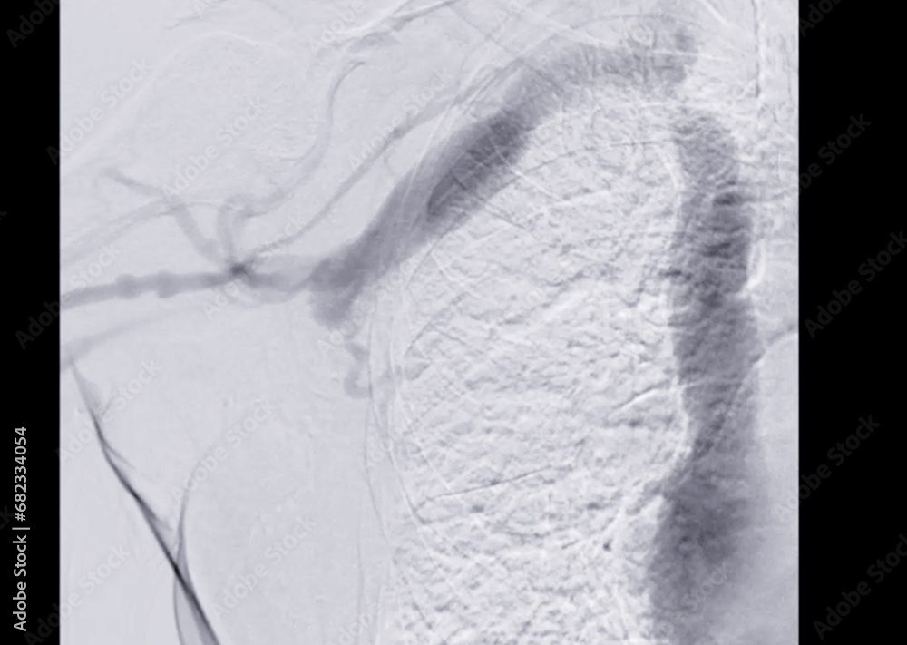 Balloon Angioplasty is a medical procedure used to widen narrowed or ...