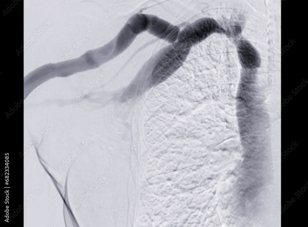 Balloon Angioplasty is a medical procedure used to widen narrowed or ...