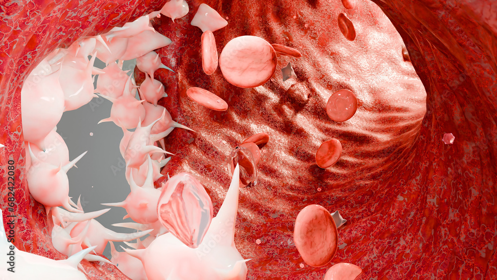 Hemostasis. Red blood cells and platelets in the blood vessel ...