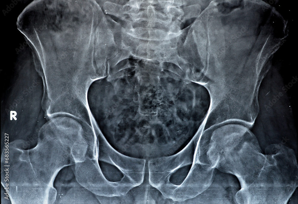 Plain X-ray of both hip joints revealed slight narrowing of ...