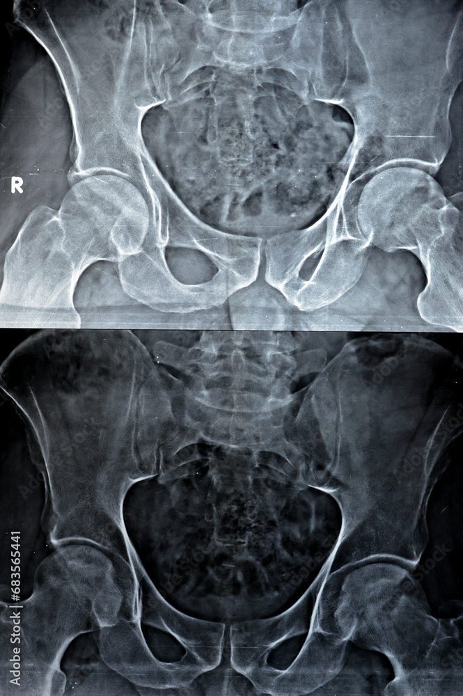 Stock-Foto „Plain X-ray of both hip joints revealed slight narrowing of ...