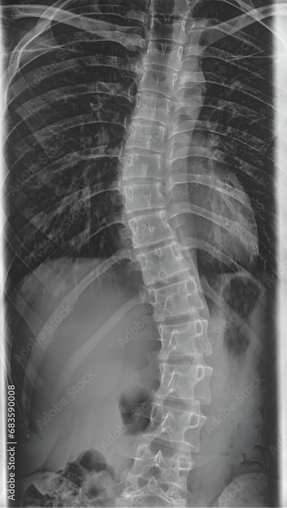 X-ray depicting scoliosis, a lateral curvature of the spine. The image ...