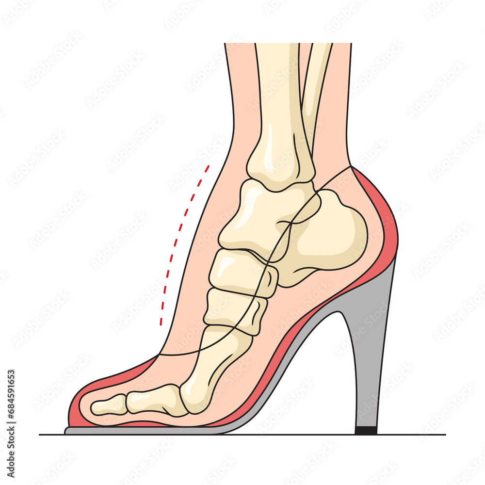 Deformation of the foot bones in high heeled shoes structure vertebral ...