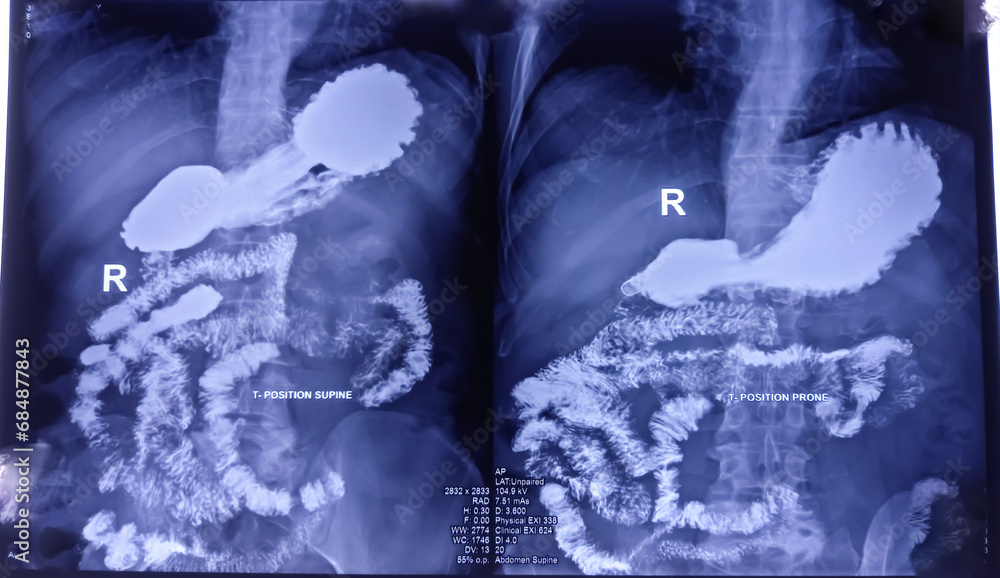 Barium swallow of oesophagus examination x-ray. showing upper digestive ...