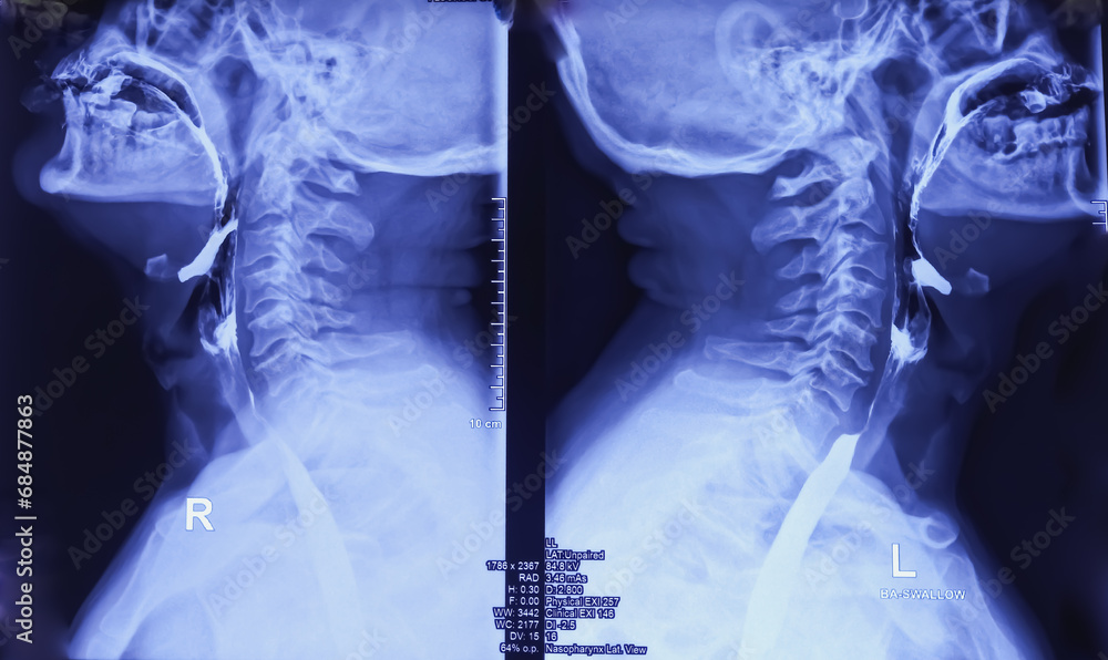 Barium swallow of oesophagus examination x-ray. showing upper digestive ...