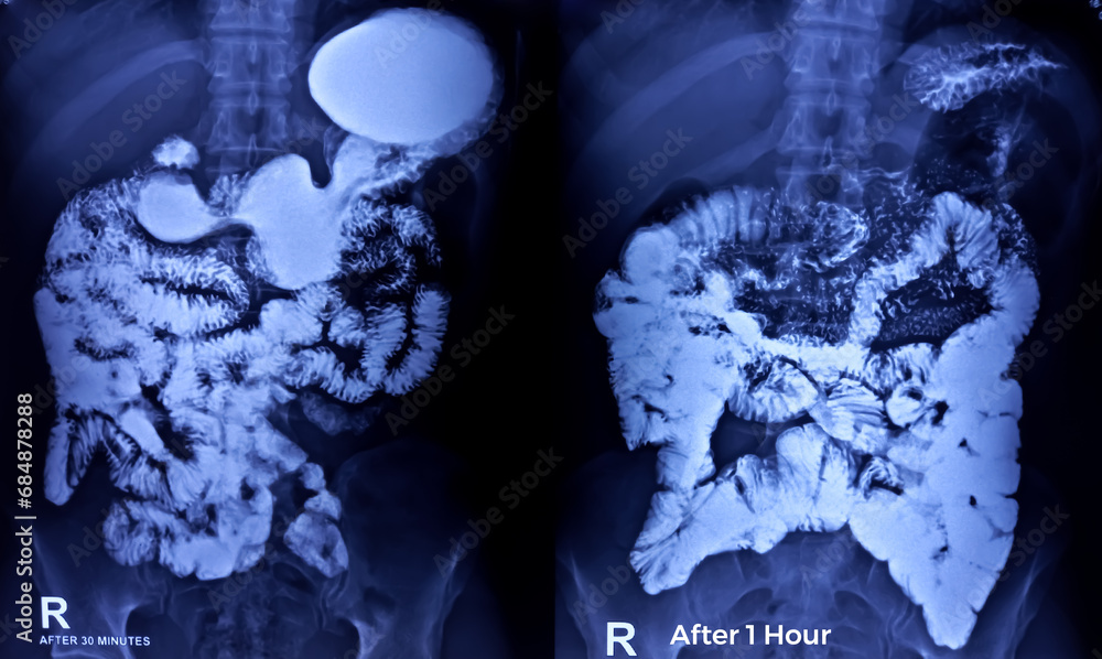 Barium swallow of oesophagus examination x-ray. showing upper digestive ...