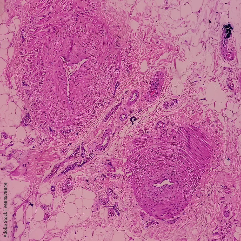Distal femur (biopsy): Exostosis. Section show mature hyaline cartilage ...