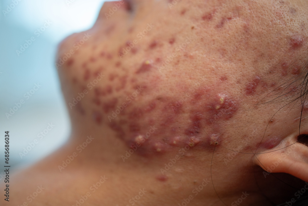 Acne on face because the disorders of sebaceous glands productions ...