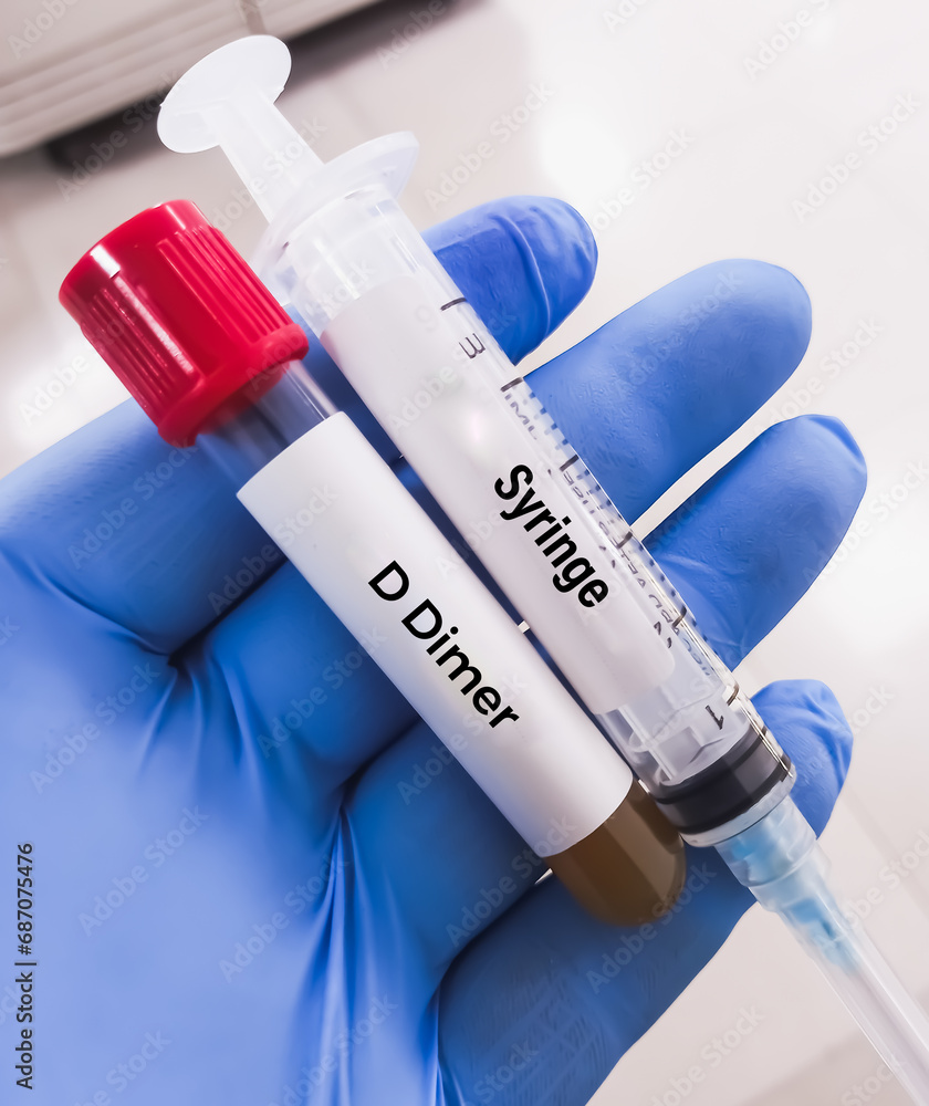 Fotografie D-Dimer test. Corona patient monitoring test in ICU. Doctor ...