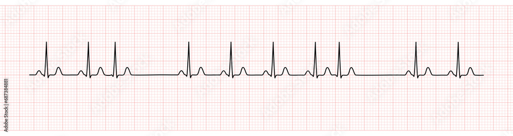 EKG Monitor Showing Sinus Rhythm with PAC Stock Vector | Adobe Stock