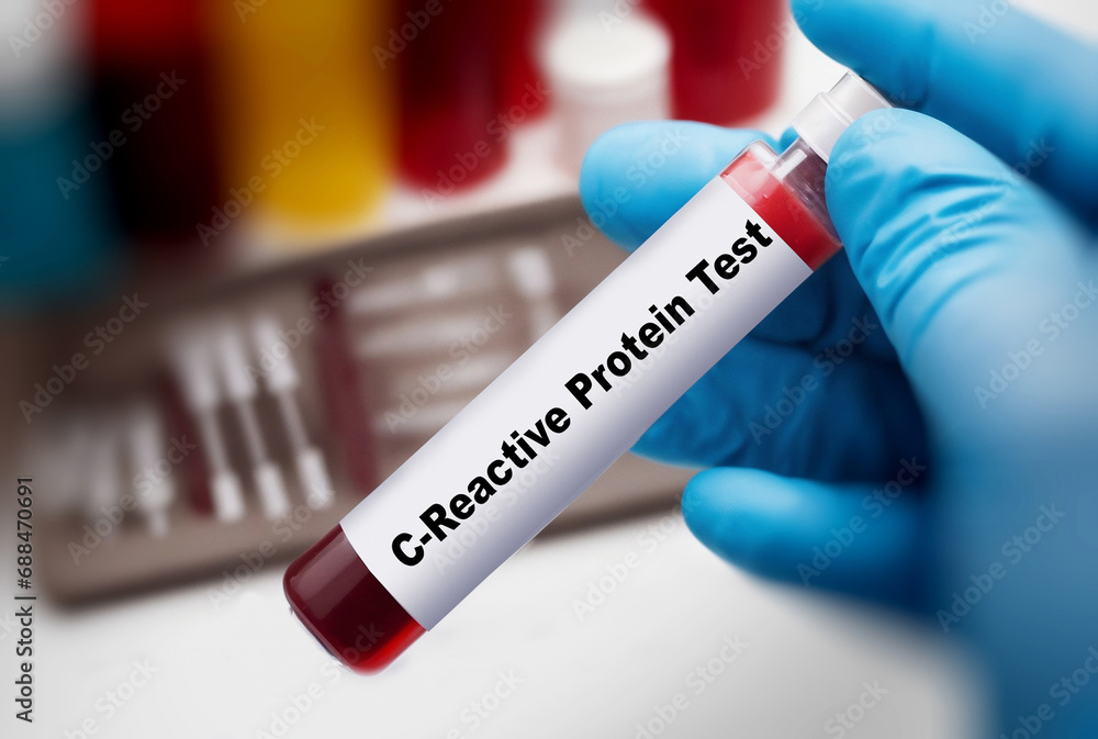 Test tube with blood sample for CRP C-reactive protein test to ...