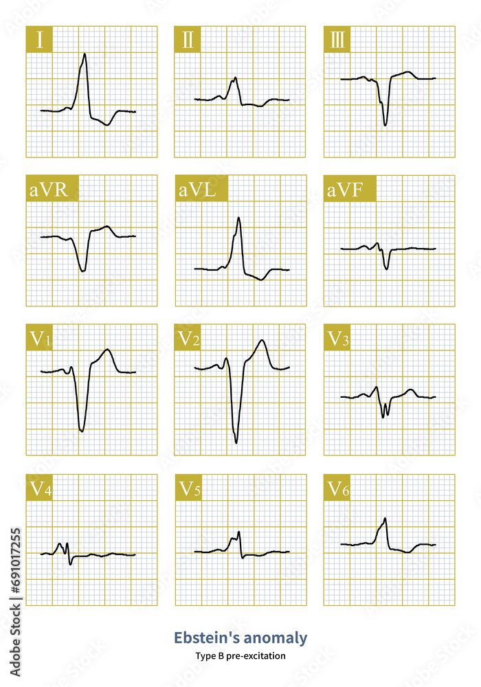 Illustration Stock Female, 42 years old, was clinically diagnosed with ...