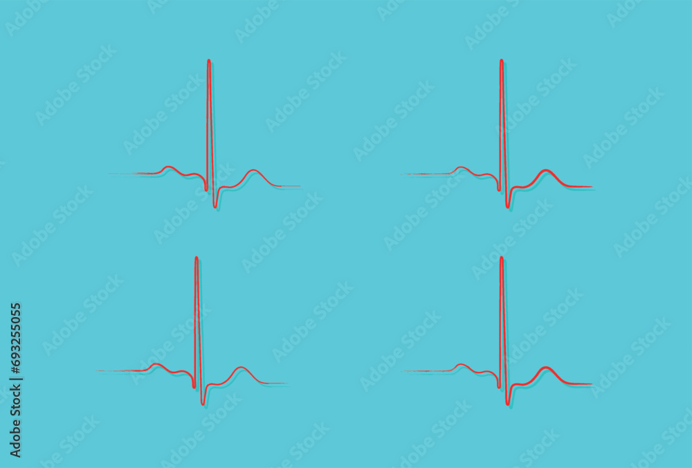 Ventricular repolarization, Cardiac cycle, ECG of heart in normal sinus ...