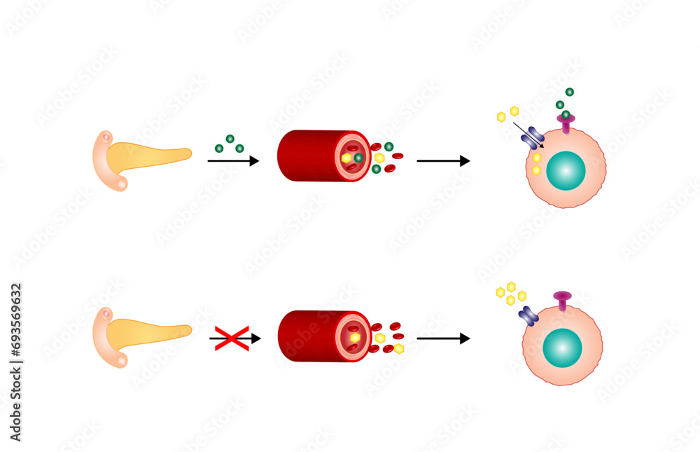 Diabetes mellitus type 1, pancreas's failure to produce enough insulin ...