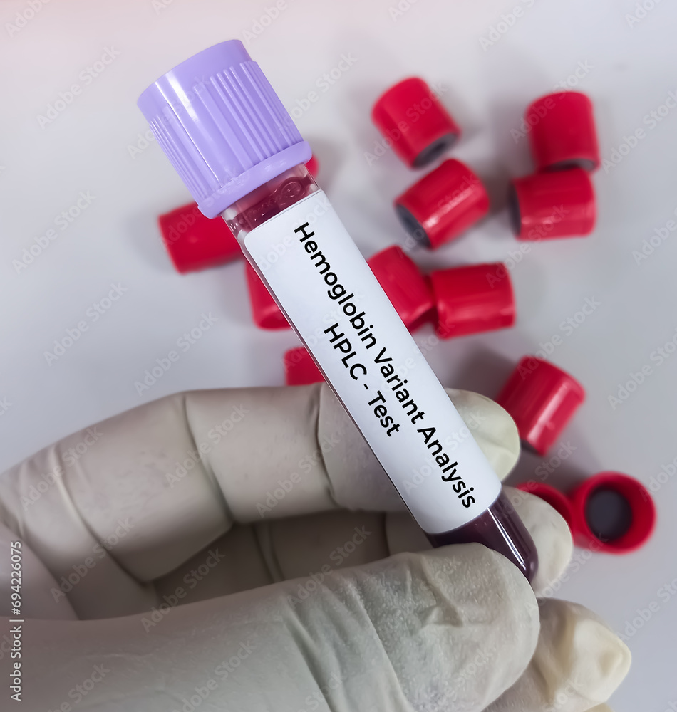 Blood sample tube for HPLC (High Performance Liquid Chromatography ...