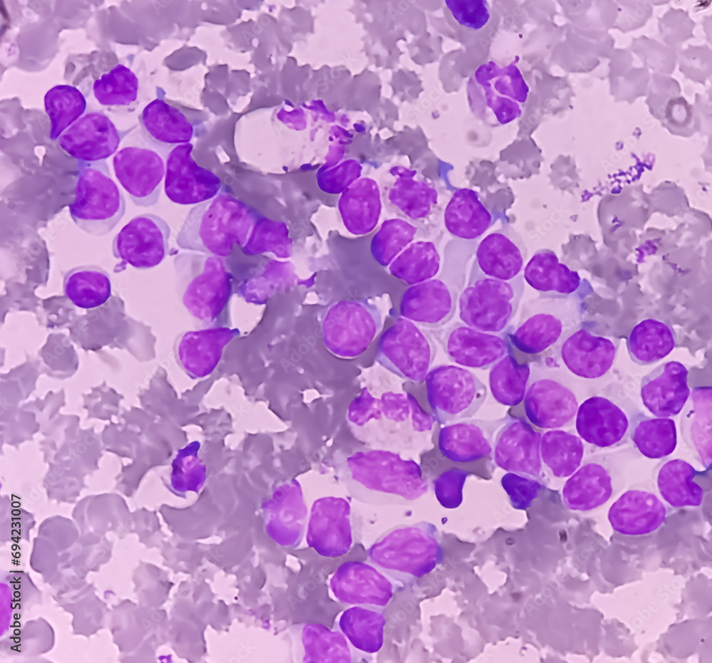 Leukemia. blood cells, blast cells and immature leukocytic cells in ...