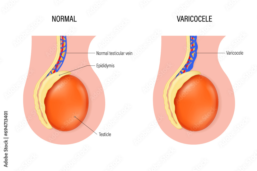 Varicocele Vector Comparison Of Normal Testicular Vein And Varicocele Testicular Disease Male