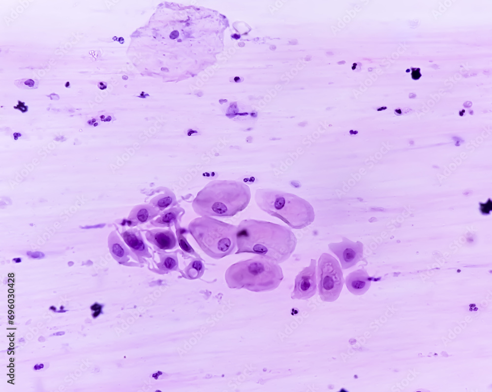 Photomicrograph of Paps smear: Inflammatory smear with HPV related ...