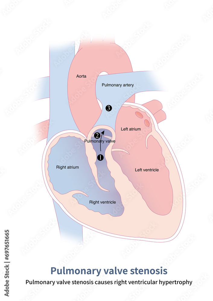 Pulmonary valve stenosis includes three conditions: ① subvalvular stenosis, that is, right ...