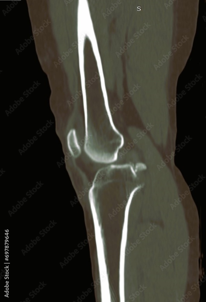 Posterior cruciate ligament (PCL) avulsion fractures Avulsion fracture ...