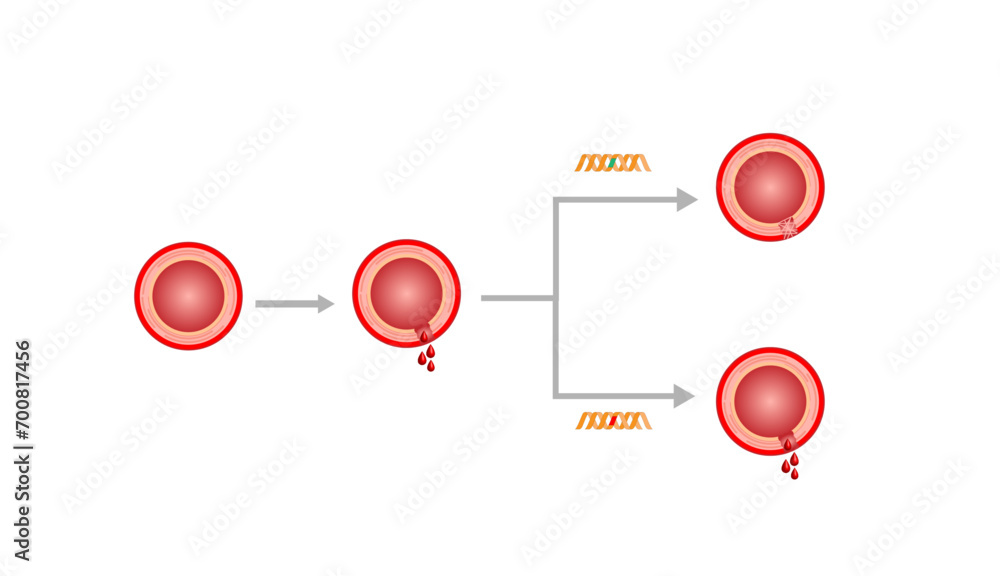 Vector de Stock Hemophilia, a bleeding disorder that slows the blood clotting. Haemophilia ...