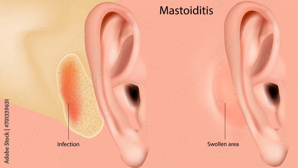 Mastoiditis. Inflammation of the mucosal lining of the mastoid antrum and mastoid air cell ...