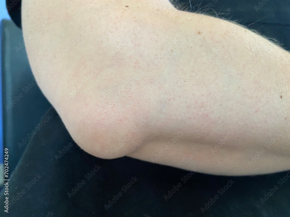 Stock-Foto „olecranon bursitis is sometimes called “Popeye’s elbow.” Bursitis is a swelling of ...