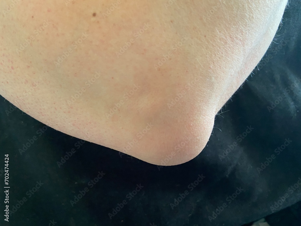 Photo Stock olecranon bursitis is sometimes called “Popeye’s elbow ...