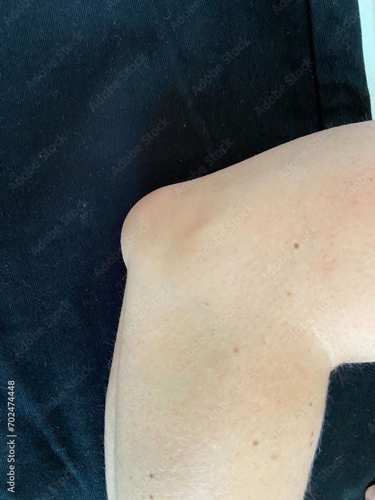 olecranon bursitis is sometimes called “Popeye’s elbow.” Bursitis is a ...