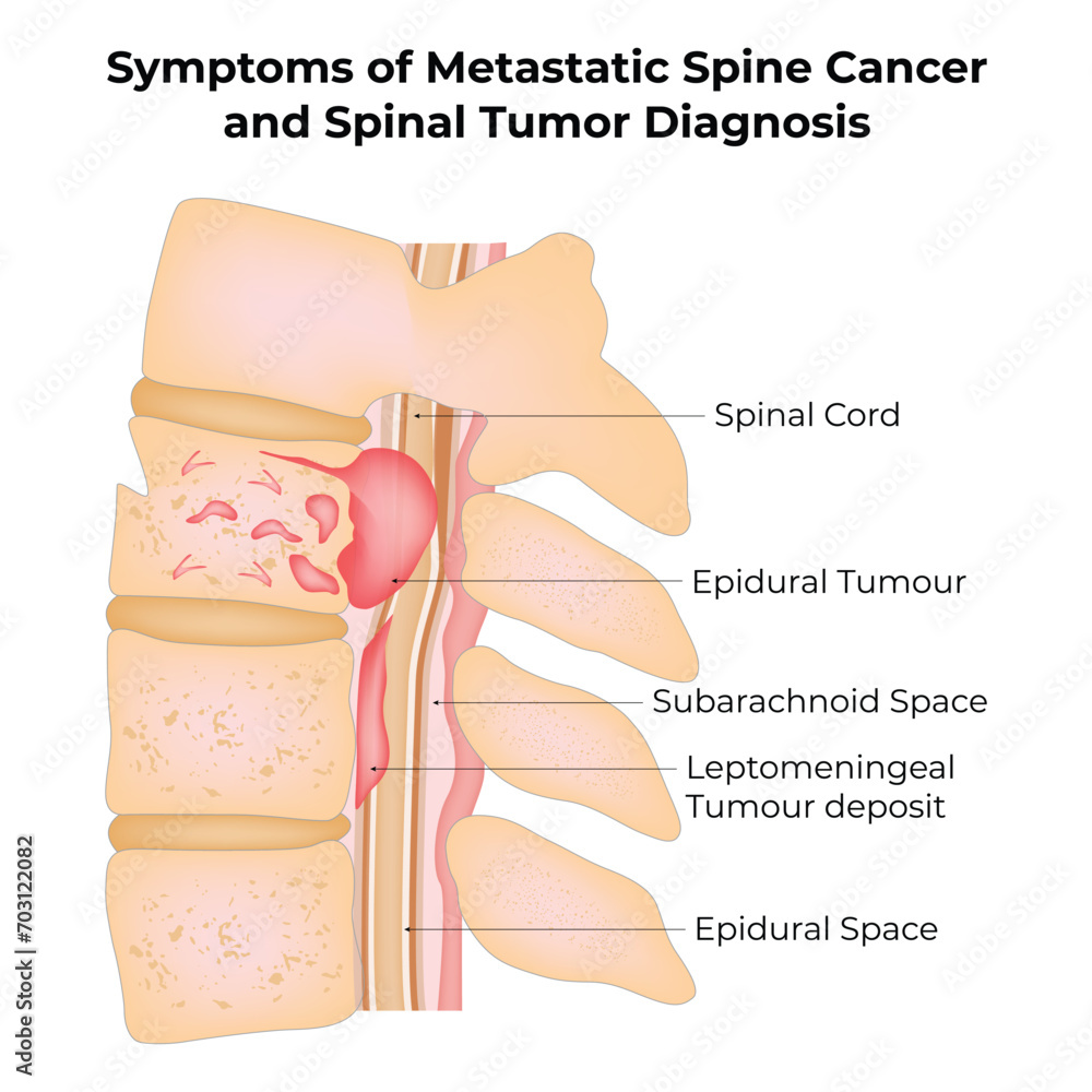 เวกเตอร์ Stock Symptoms of Metastatic Spine Cancer and Spinal Tumor Diagnosis Science Design ...