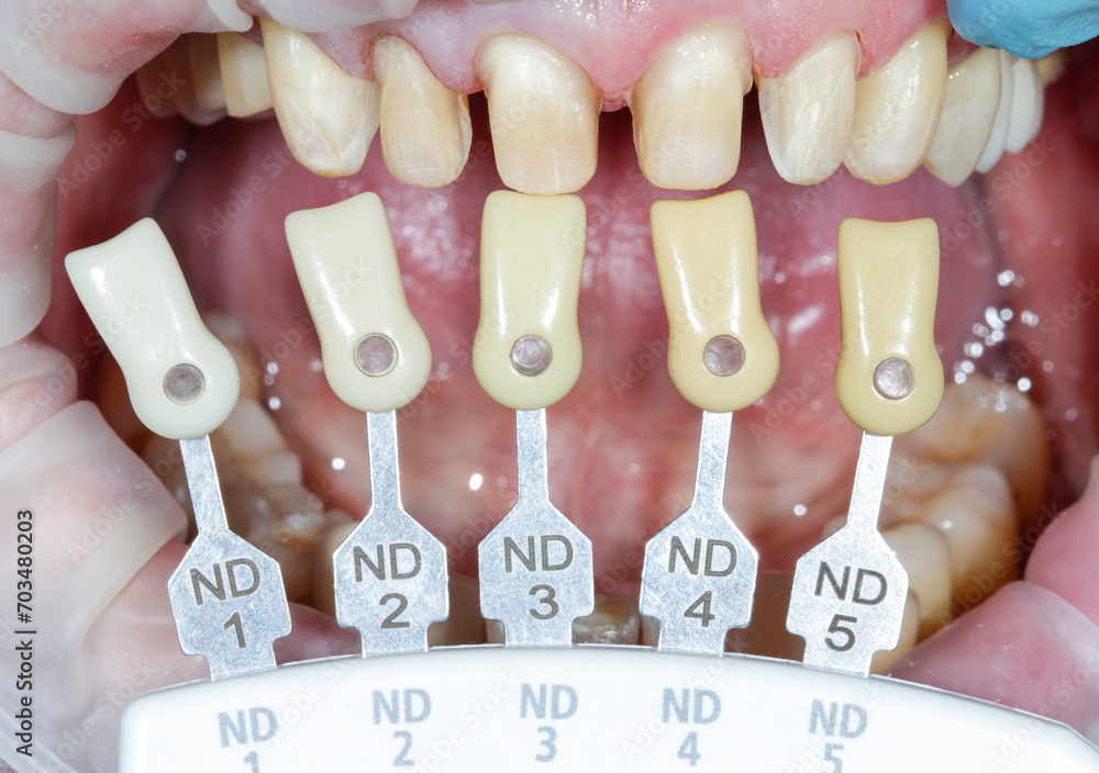 Anterior tooth preparation for dental crown build-up. Scale for ...