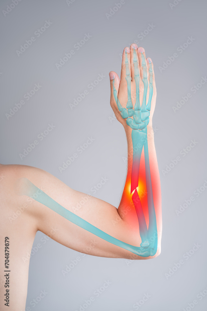 Bone fracture and inflammation, broken arm, diseases of the joint, man ...