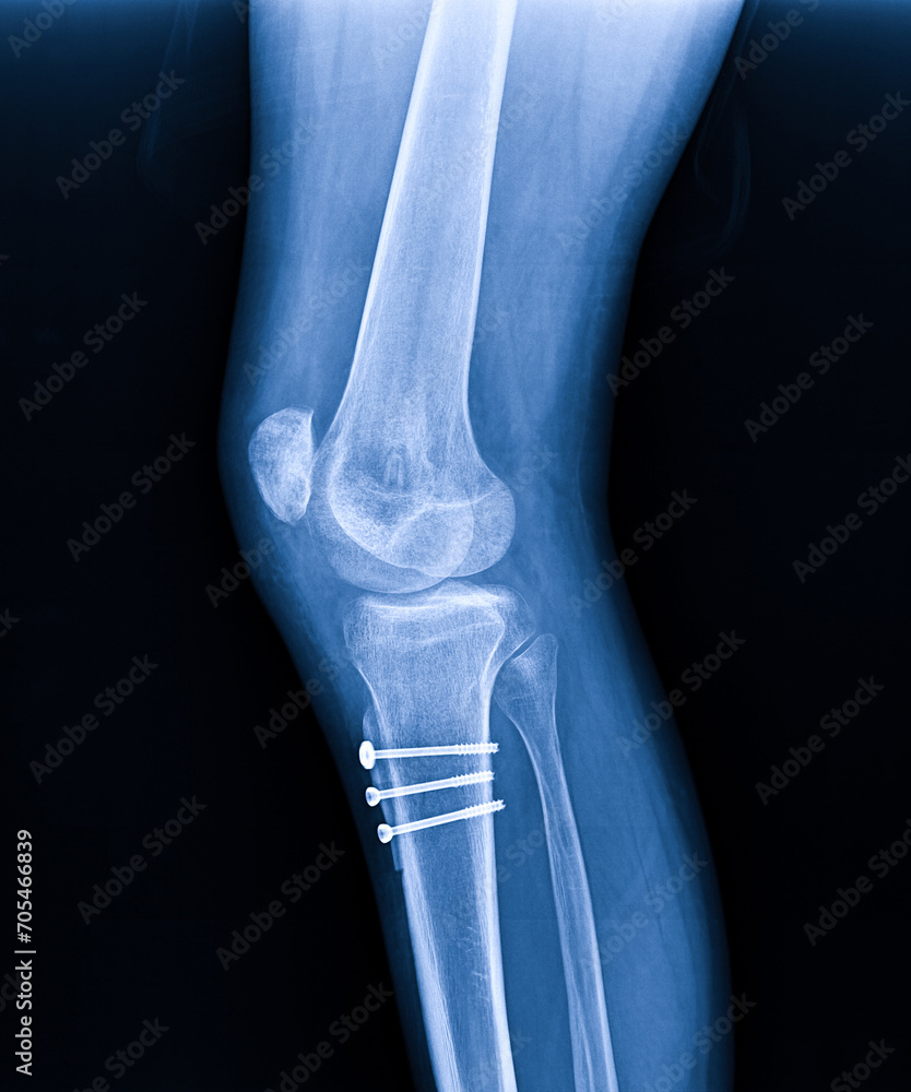 Stock-Foto „X-ray Knee Joint Fracture proximal tibia and Post fix ...