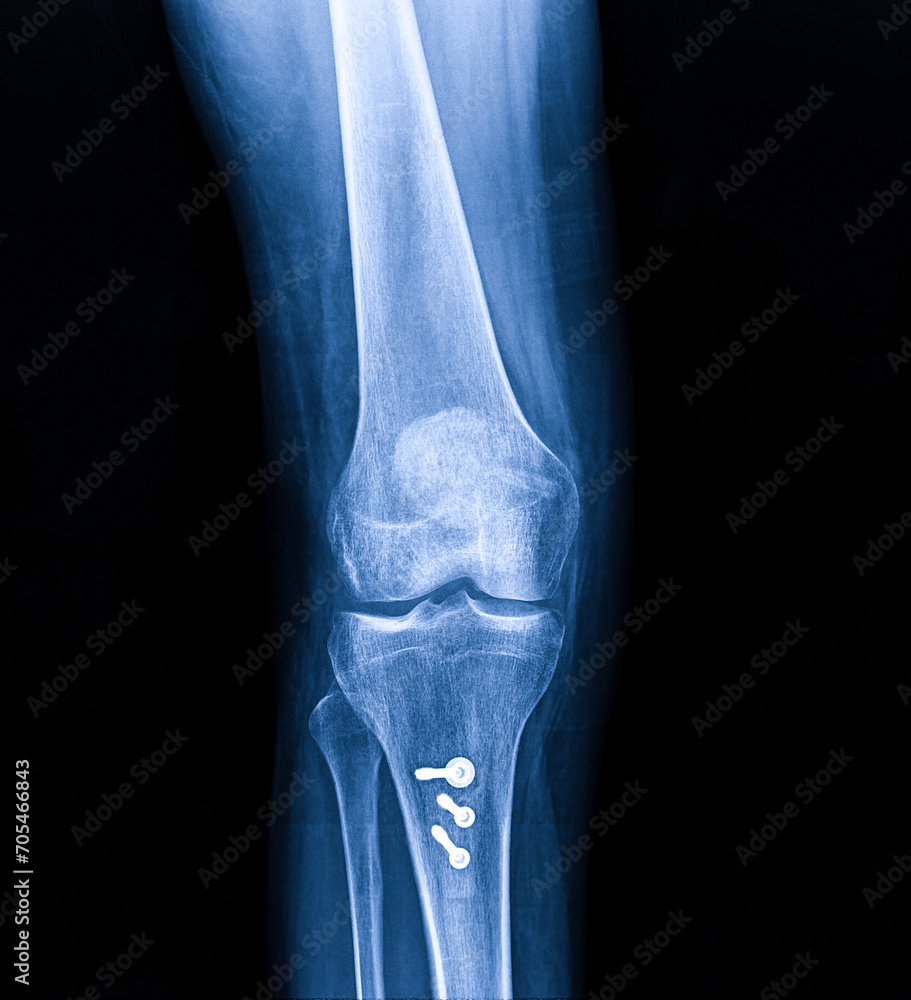 Stock-Foto „X-ray Knee Joint Fracture proximal tibia and Post fix ...