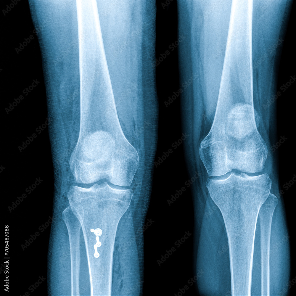 X-ray Knee Joint Fracture proximal tibia and Post fix fracture proximal ...
