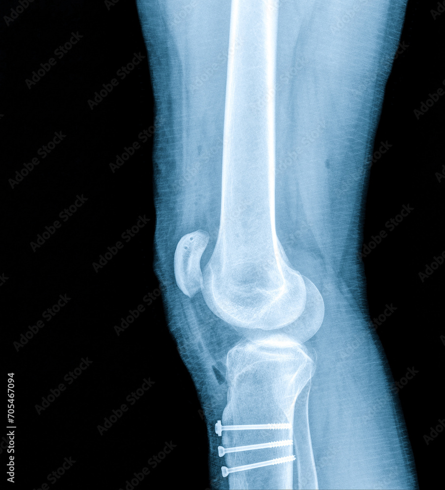 Stock-Foto „X-ray Knee Joint Fracture proximal tibia and Post fix ...