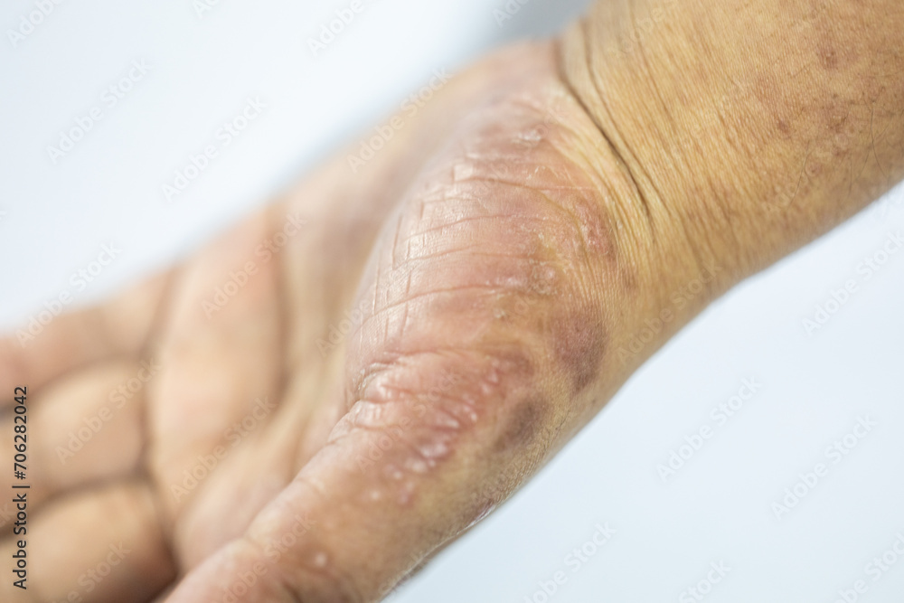 Atopic dermatitis (AD), also known as atopic eczema, is a type of ...